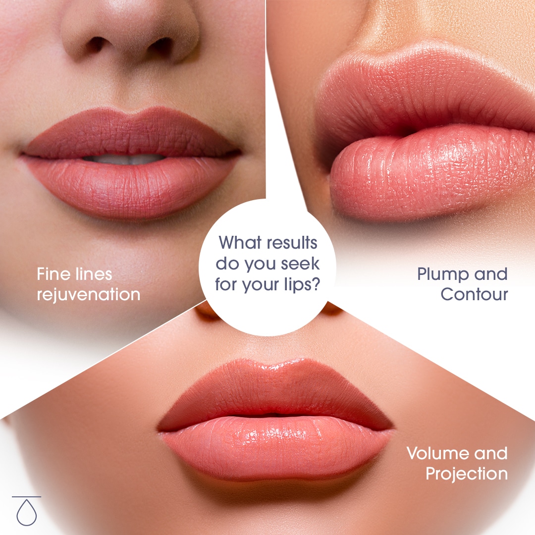 How to have dermal filler for your lips and look absolutely natural ...